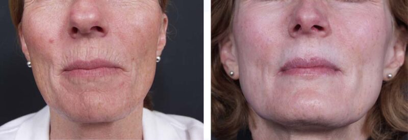 Dermabrasion Photos | Scottsdale Plastic Surgeon Dr. Parson