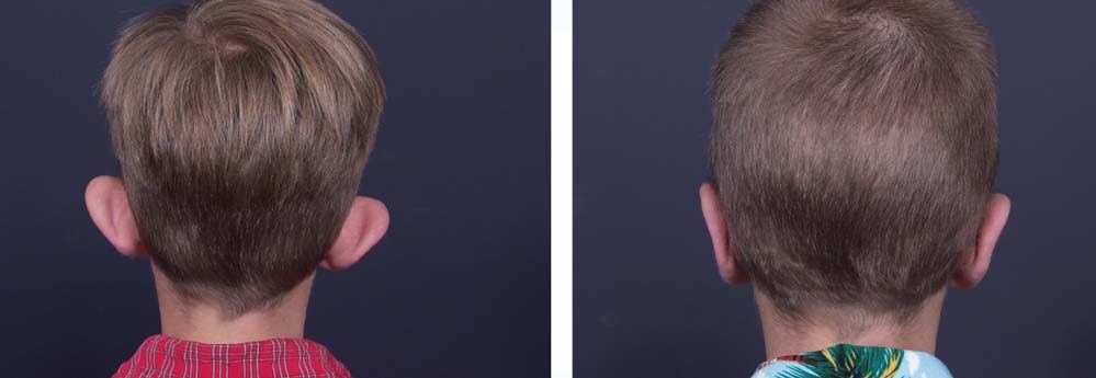 Ear Surgery Otoplasty Photos Dr Shaun Parson Scottsdale Arizona