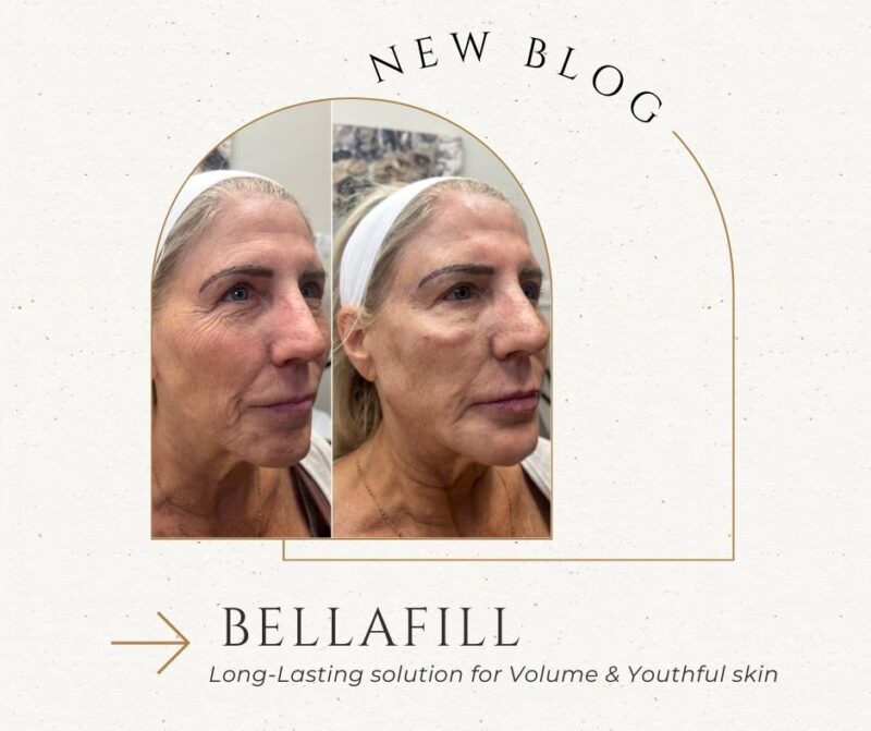 Bellafill with Jake Collins | Dr. Shaun Parson, Scottsdale