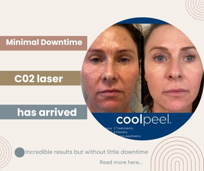 CoolPeel The revolutionary laser| Dr. Shaun Parson, Scottsdale